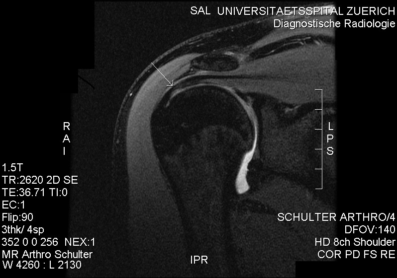 What imaging pathologies are associated with shoulder pain? - Mend Colorado